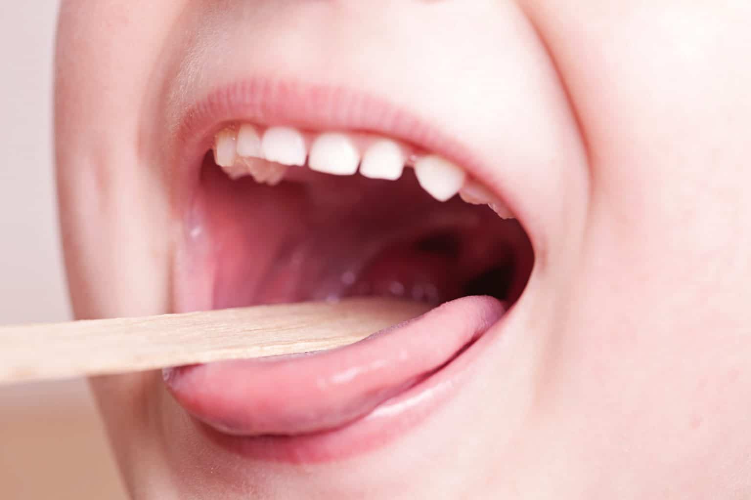 Pediatric Tonsil Infections | Ear, Nose and Throat Surgical Associates ...